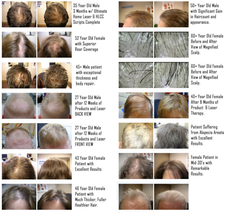 Before & After - Graff Hair Technology